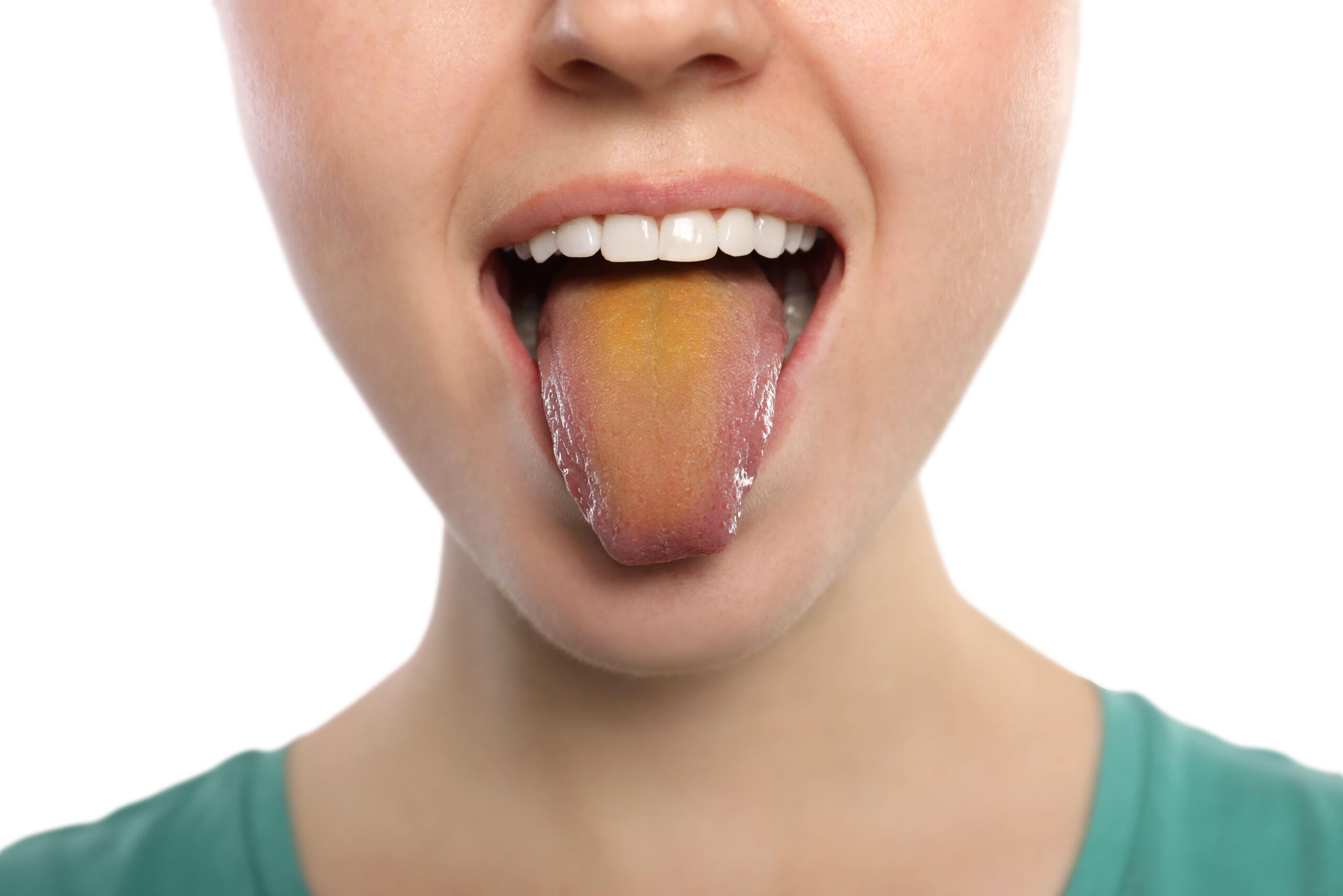 Gelbe Zunge - Ursachen, Behandlung und Prävention - Medentes